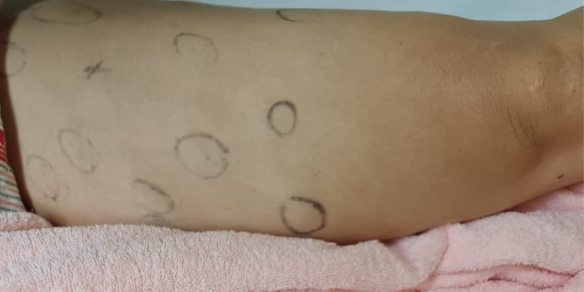 The Lipoma: Is It Cancer? | Cha Surgery